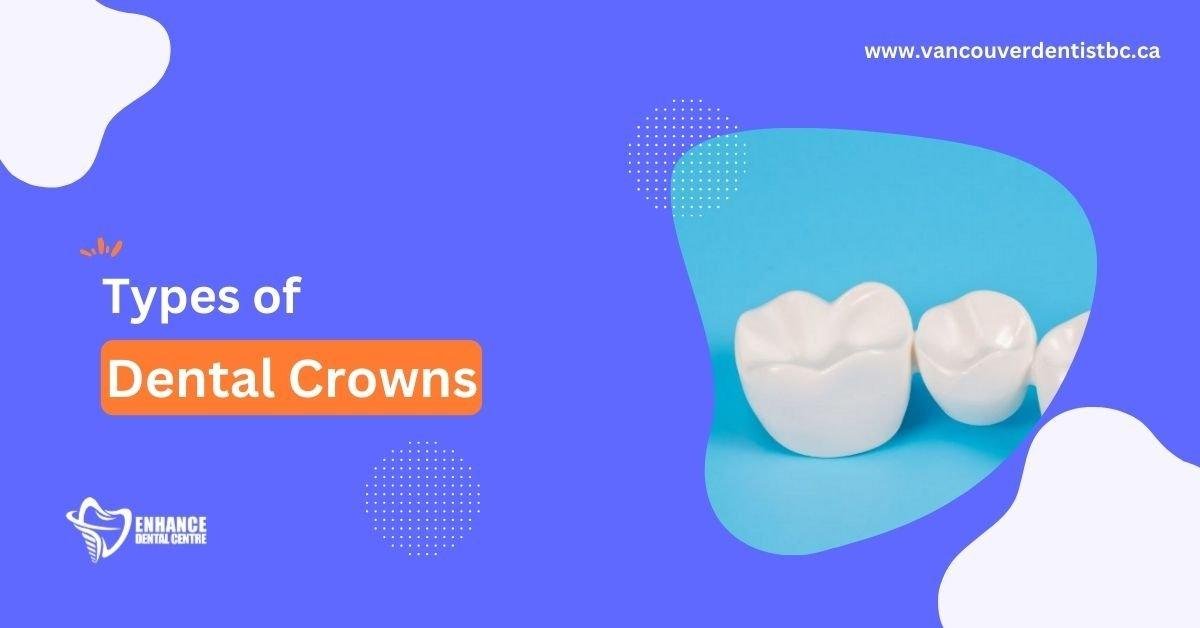 What are the Different Types of Dental Crowns? – Enhance Dental care