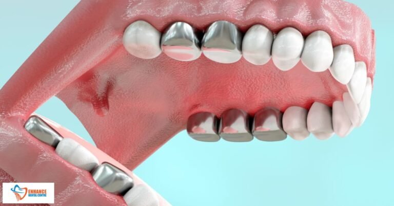 What are the Different Types of Dental Crowns? - Enhance Dental CA