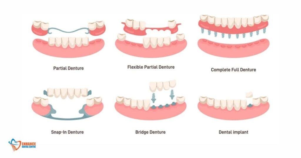 What Are Dentures? - Enhance Dental CA