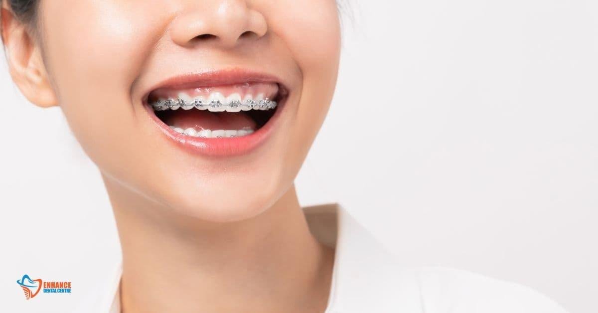 Which is Faster? Braces Vs. Invisalign – Enhance Dental care