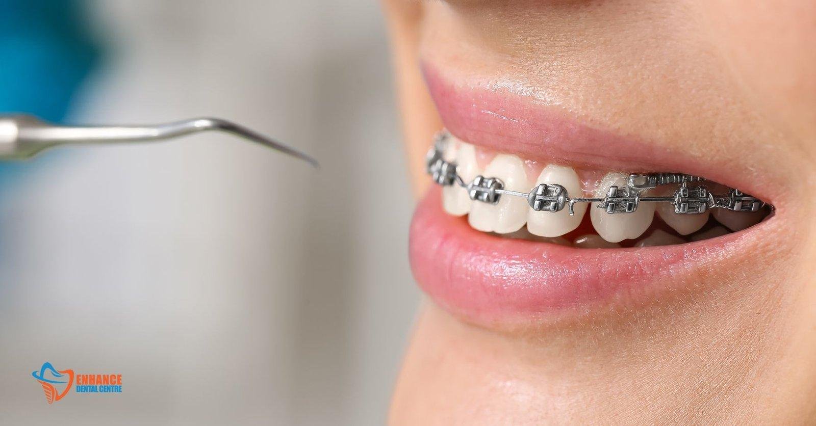 What Are Orthodontic Services? (From Braces to Invisalign) – Enhance ...