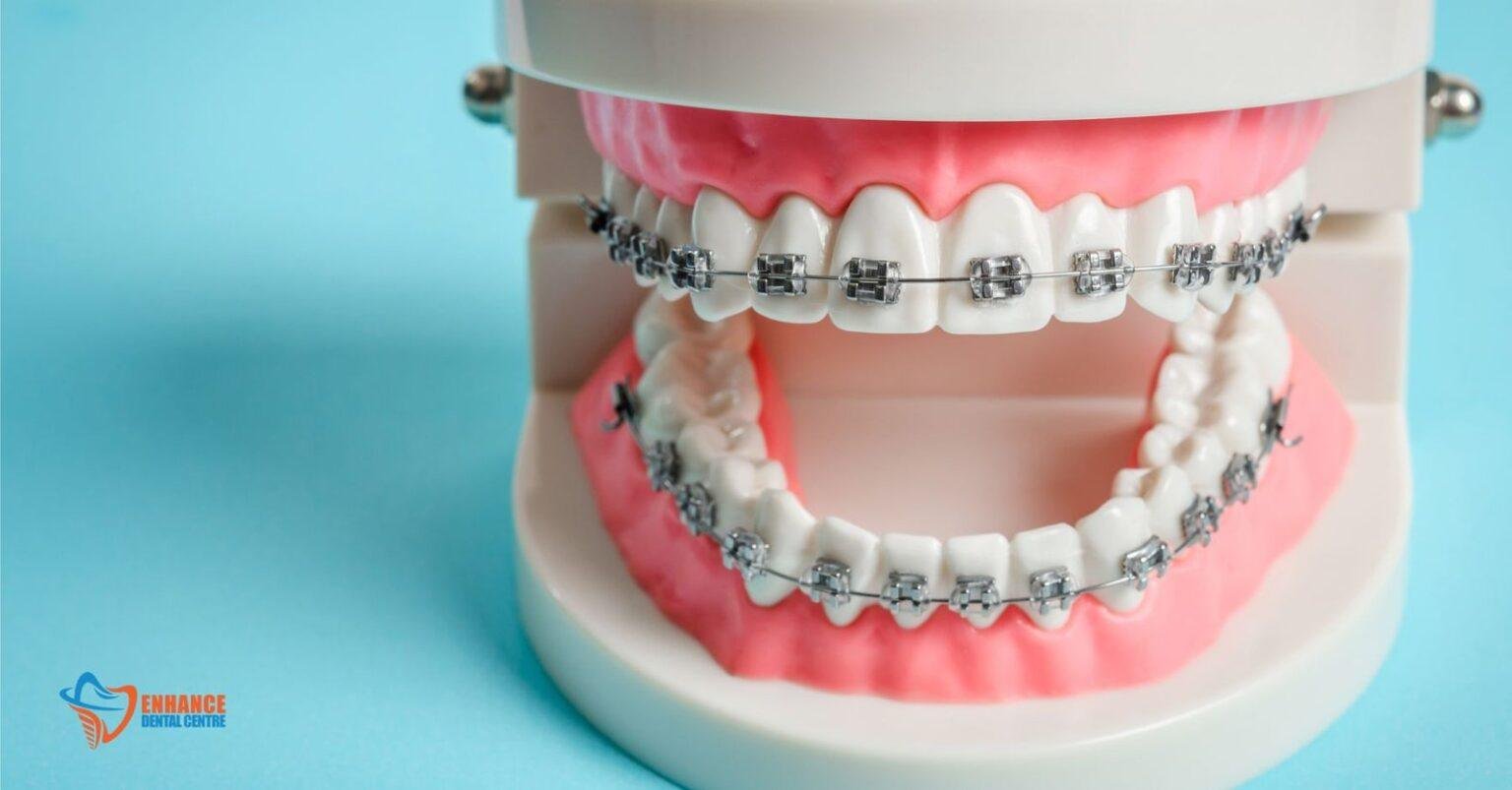 What Are Orthodontic Services? (From Braces to Invisalign) – Enhance ...