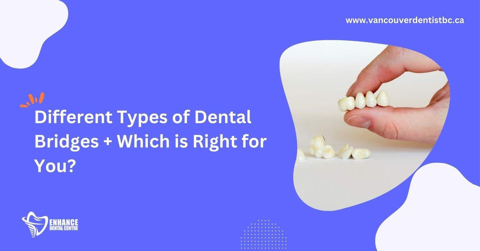 Different Types of Dental Bridges: Which is Right for You? – Enhance ...