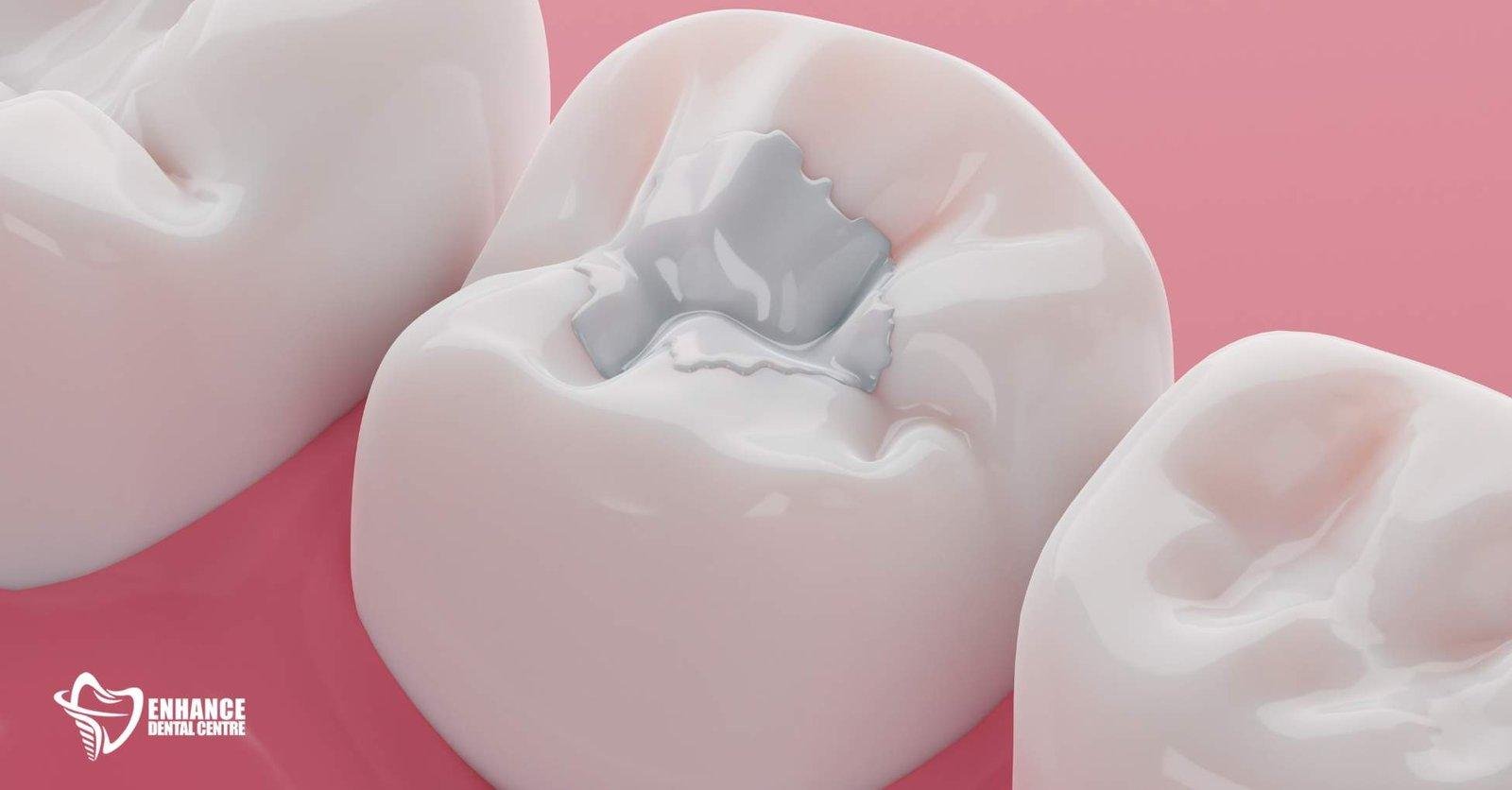 Why Choose Composite Fillings? Key Benefits Explained! – Enhance Dental ...