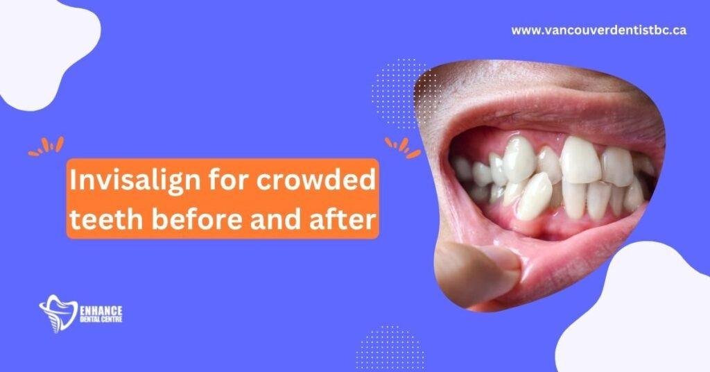 Swelling After Tooth Extraction (Causes, Treatments, and Essential Tips)